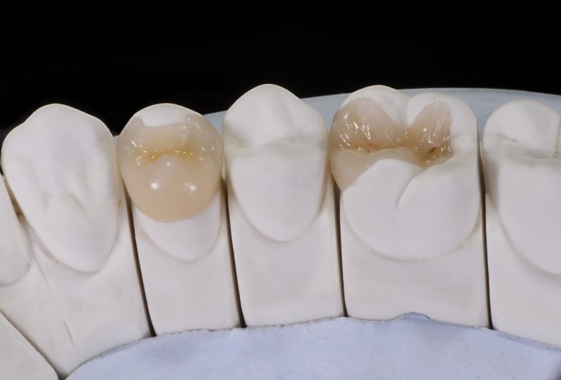 How Do Dental Crowns Differ from Fillings? |Sunny Dental